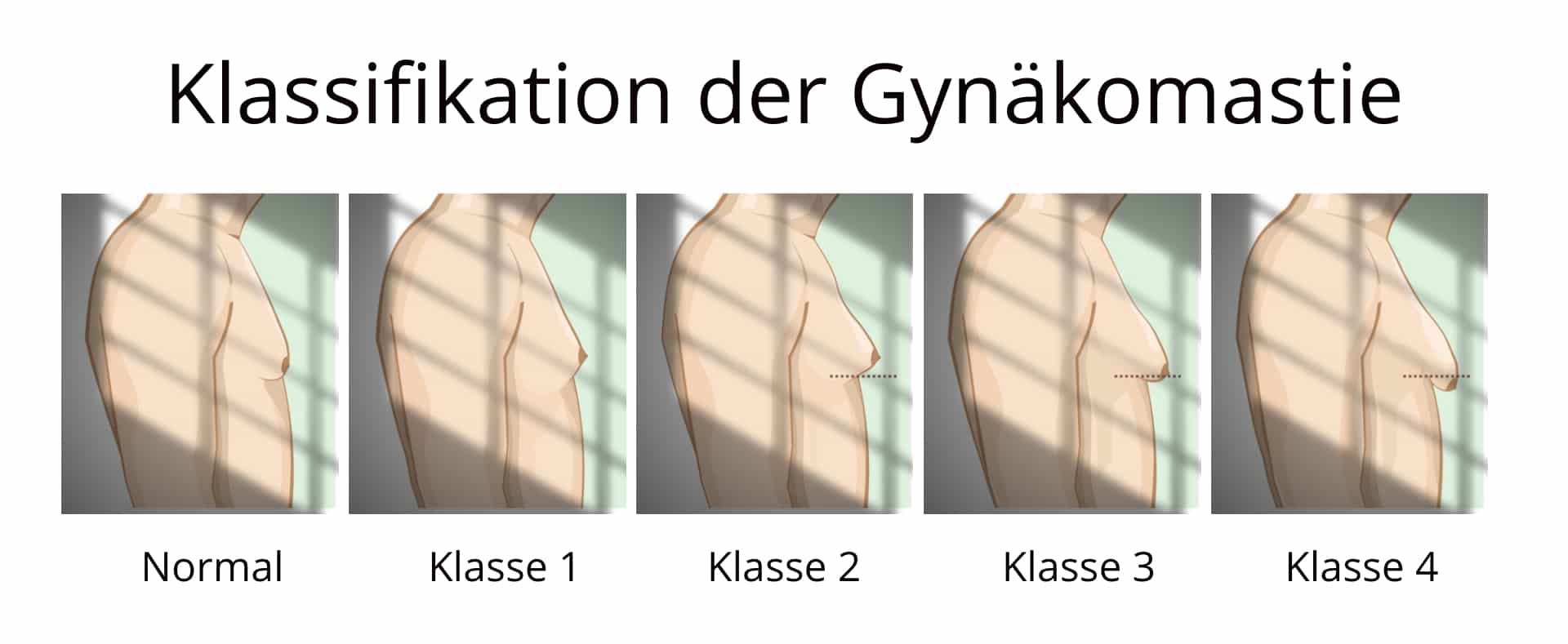 Der Entwicklungsprozess der Gynäkomastie - Ästhetik all